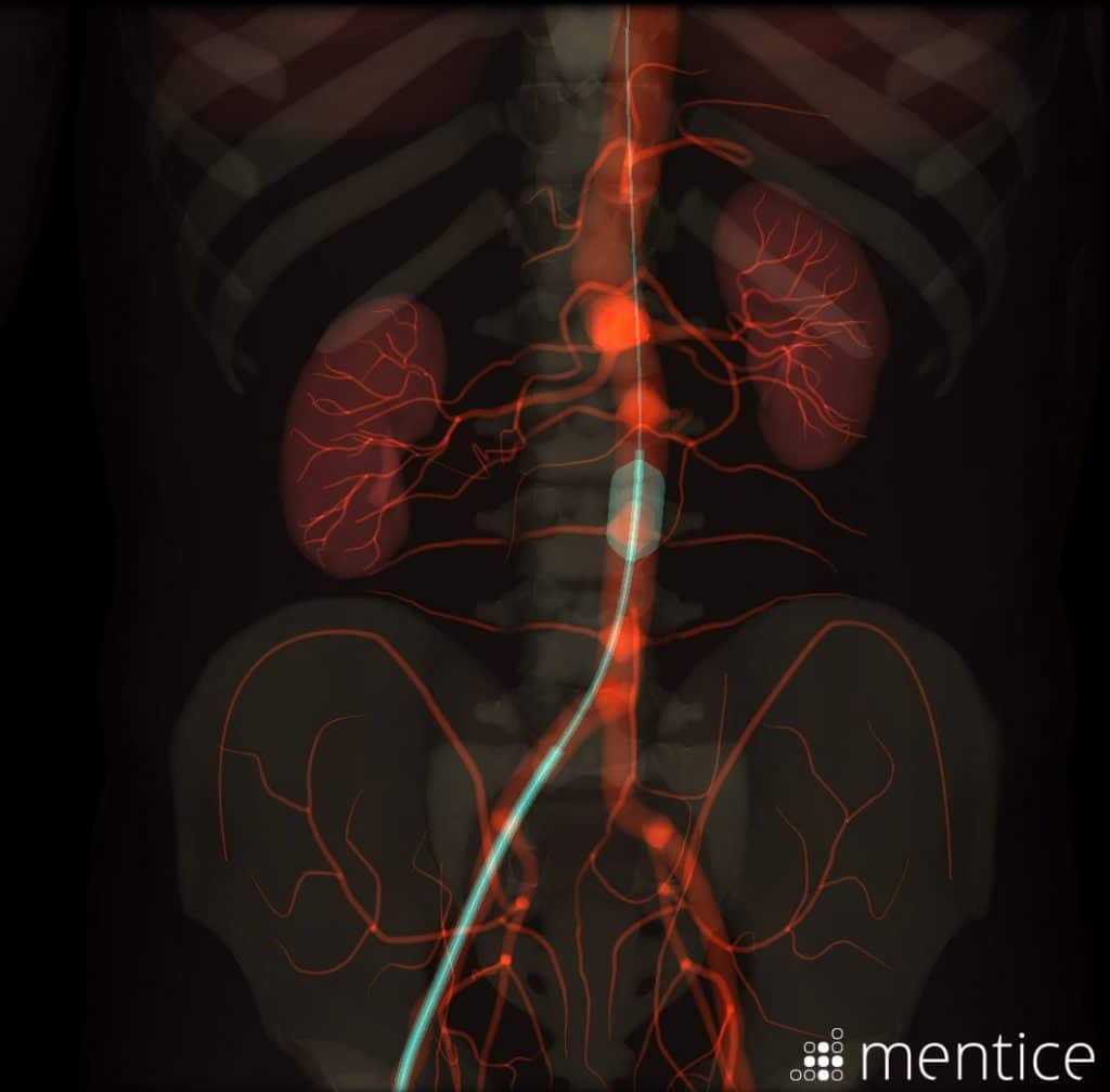 As more trauma surgeons adopt REBOA, simulation is key to closing gap ...