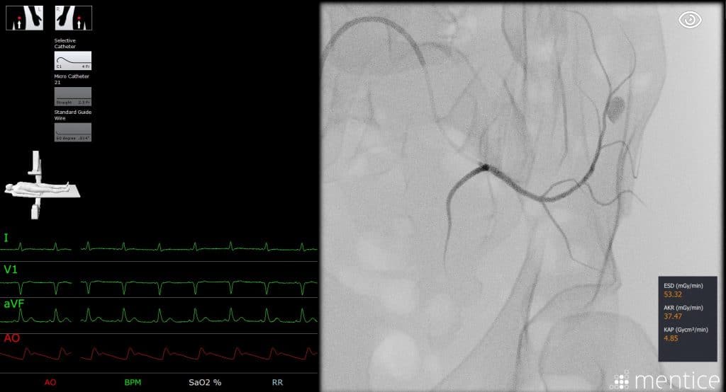 As more trauma surgeons adopt REBOA, simulation is key to closing gap ...