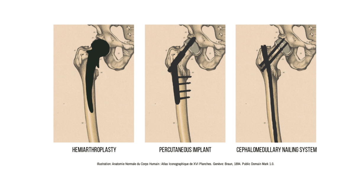 Isolated Hip Fracture: What trauma registrars need to know - Trauma ...