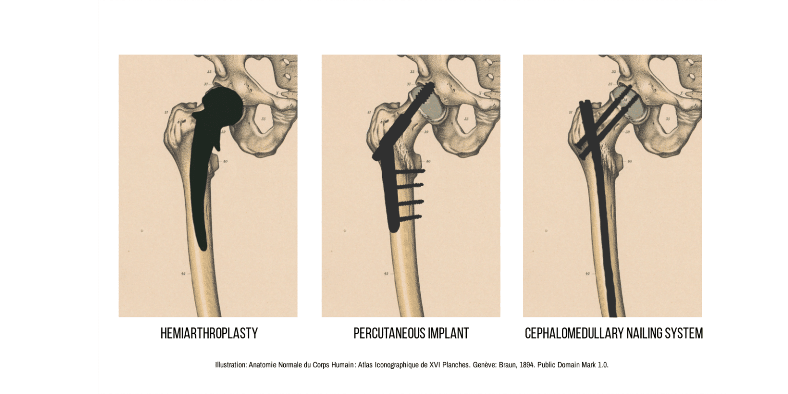 Isolated Hip Fracture: What trauma registrars need to know - Trauma ...
